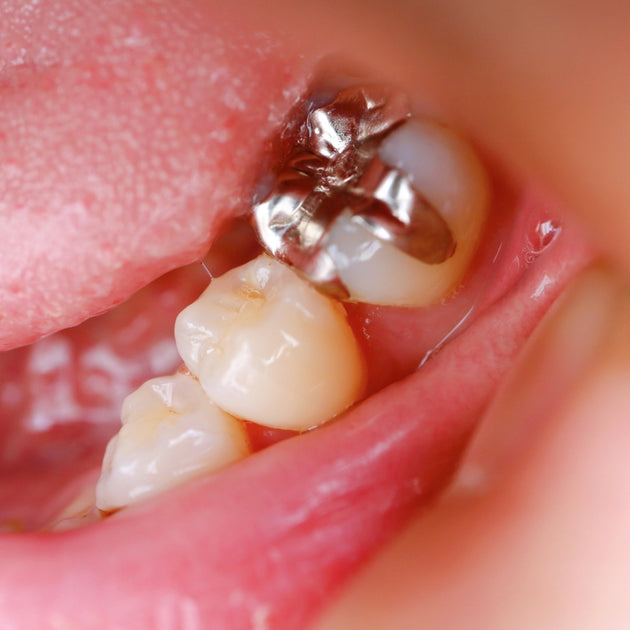 The Dangers of Amalgam Fillings | Dale Audrey R.D.H.